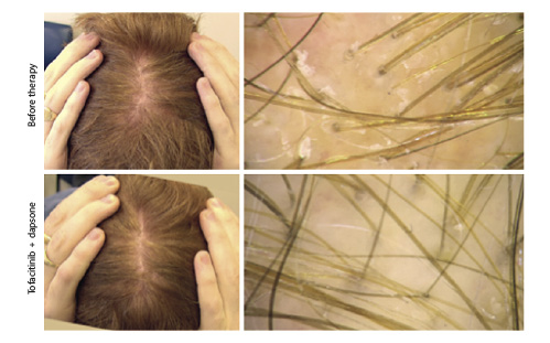 Hair Loss in Lichen Planopilaris and Frontal Fibrosing Alopecia: Not ...
