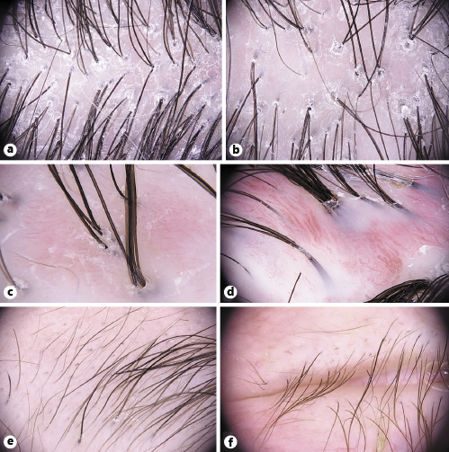 The Role of Trichoscopy in Keratosis Follicularis Spinulosa Decalvans ...