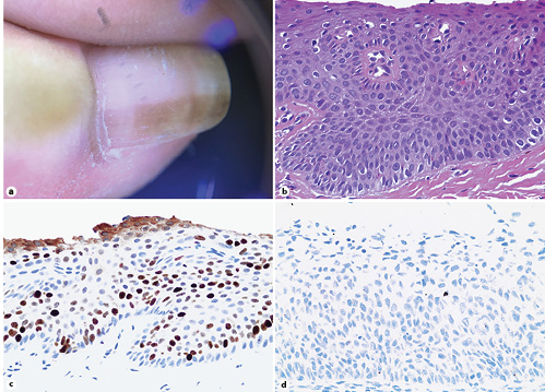 Monodactylous Longitudinal Melanonychia: A Sign of Bowen’s Disease in ...
