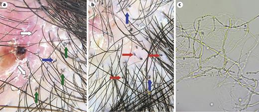 A Rare Case of Coexisting Pediculosis Capitis and Tinea Capitis in a ...