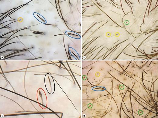 Trichotillomania: What Do We Know So Far? | Skin Appendage Disorders ...