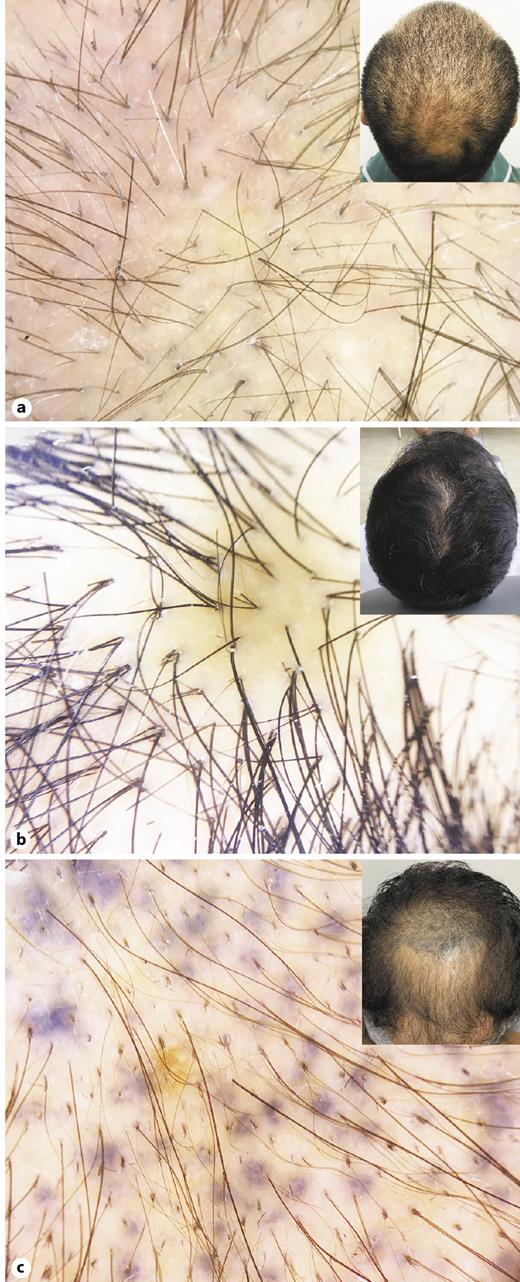 Patterned Trichoteiromania in Androgenetic Alopecia | Skin Appendage ...