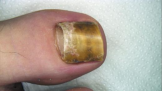 Chronic Retronychia: Nonsurgical Treatment | Skin Appendage Disorders ...