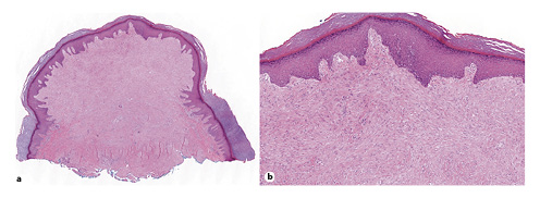 Infantile Digital Fibromatosis/Inclusion Body Fibromatosis: A ...