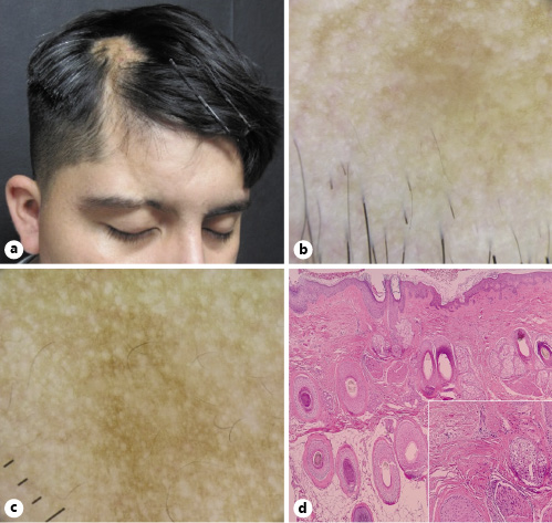 Hair Disorders in Autoimmune Diseases | Skin Appendage Disorders ...