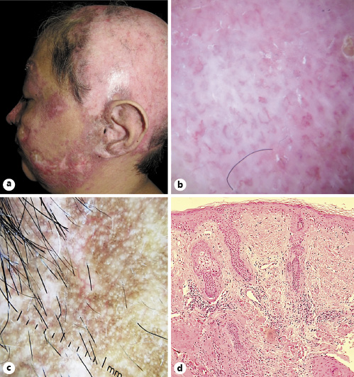 Hair Disorders in Autoimmune Diseases | Skin Appendage Disorders ...