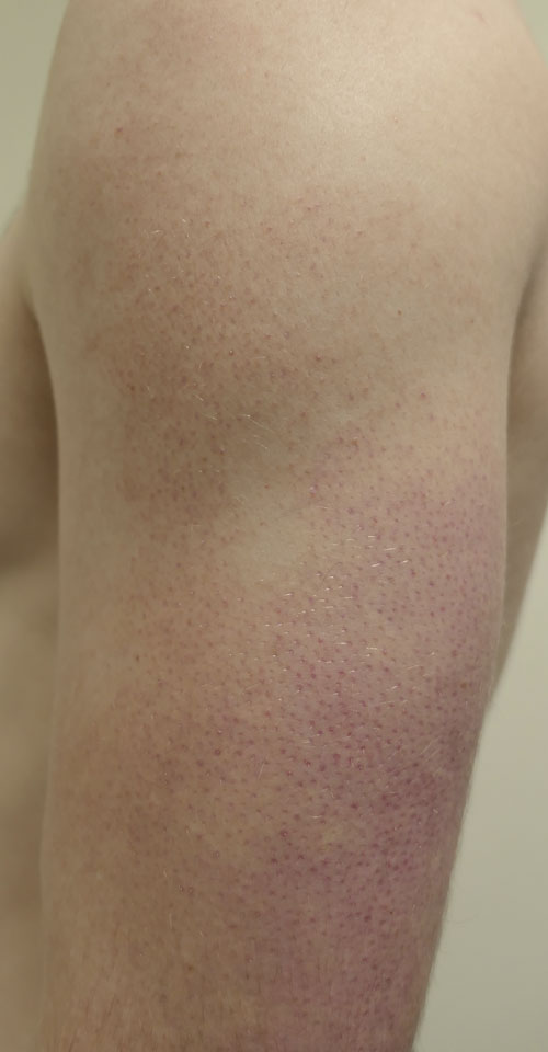 A Review of the Scoring and Assessment of Keratosis Pilaris | Skin ...