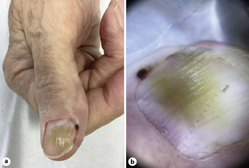 Nail Unit Squamous Cell Carcinoma with Onycholemmal Features: Case ...