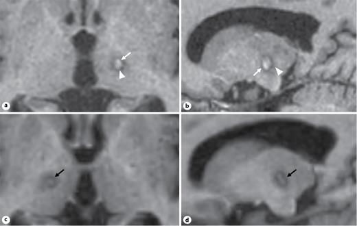 Bilateral Radiofrequency Ventral Intermediate Thalamotomy for Essential ...