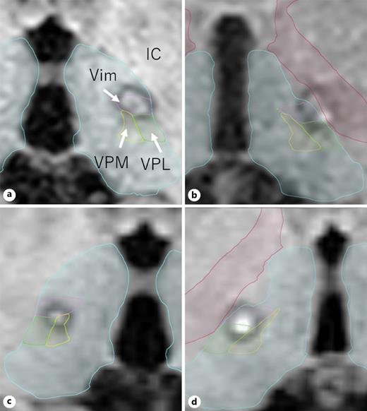 Bilateral Radiofrequency Ventral Intermediate Thalamotomy for Essential ...