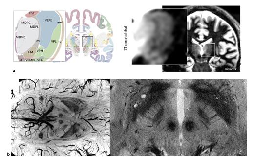 Advances in Technical Aspects of Deep Brain Stimulation Surgery ...