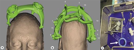 Advances in Technical Aspects of Deep Brain Stimulation Surgery ...