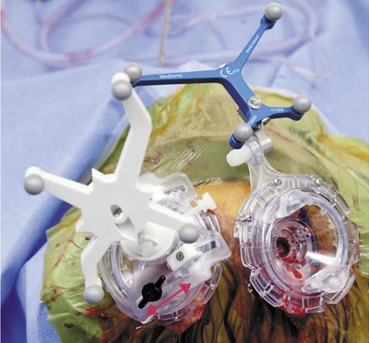 Advances in Technical Aspects of Deep Brain Stimulation Surgery ...