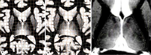 Advances in Technical Aspects of Deep Brain Stimulation Surgery ...