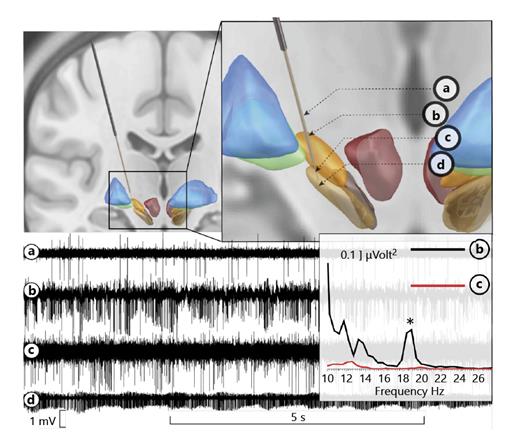 Advances in Technical Aspects of Deep Brain Stimulation Surgery ...