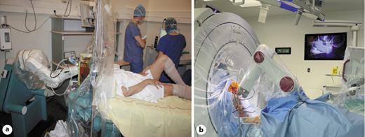 Advances in Technical Aspects of Deep Brain Stimulation Surgery ...