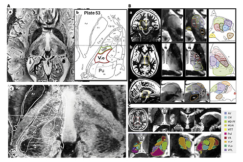 Advanced Imaging and Direct Targeting of the Motor Thalamus and Dentato ...
