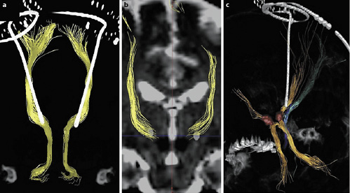 Advanced Imaging and Direct Targeting of the Motor Thalamus and Dentato ...