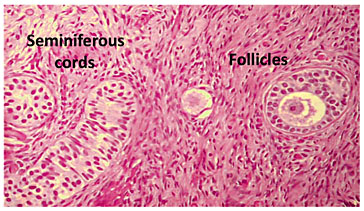 Disorders of Sex Development with Testicular Differentiation in SRY ...