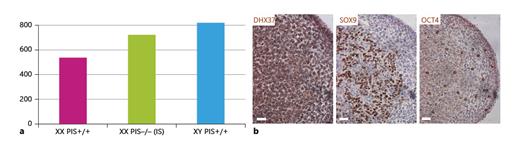 DHX37 and 46,XY DSD: A New Ribosomopathy? | Sexual Development | Karger ...