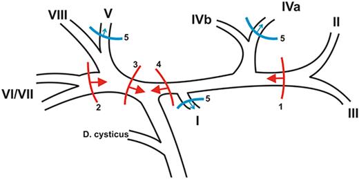 Limits of Surgical Resection for Bile Duct Cancer | Visceral Medicine ...