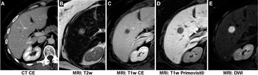 Imaging Procedures for Colorectal Cancer | Visceral Medicine | Karger ...