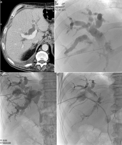 Leakage of Hepaticojejunal Anastomosis: Radiological Interventional ...