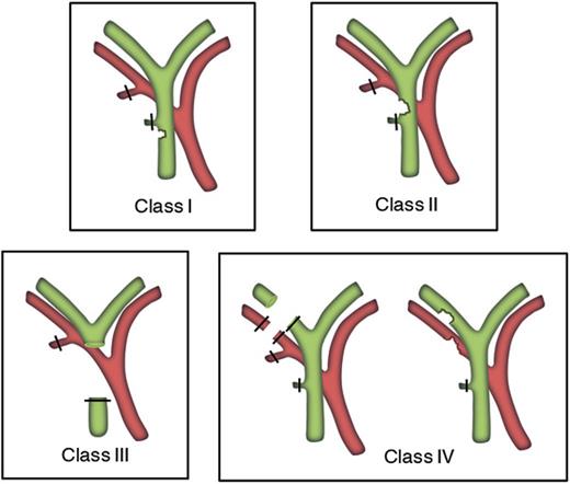 Bile Duct Injury after Cholecystectomy: Surgical Therapy | Visceral ...