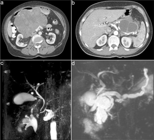 Pancreatic Cystic Neoplasms: Different Types, Different Management, New ...