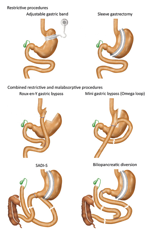 Malnutrition as a Complication of Bariatric Surgery – A Clear and ...