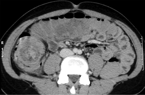 Adult Intussusception: An Uncommon Condition and Challenging Management ...