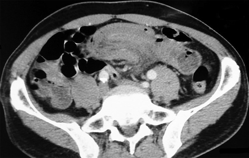 Adult Intussusception: An Uncommon Condition and Challenging Management ...