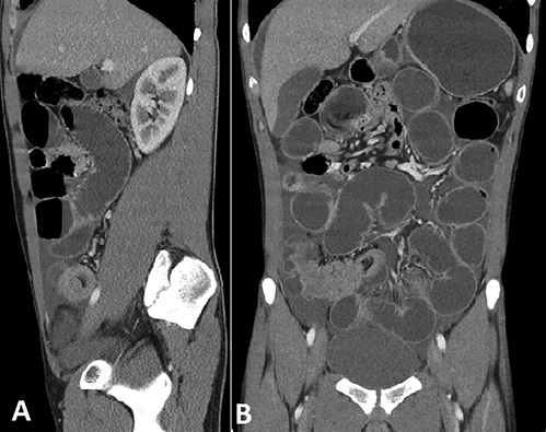 Adult Intussusception: An Uncommon Condition and Challenging Management ...