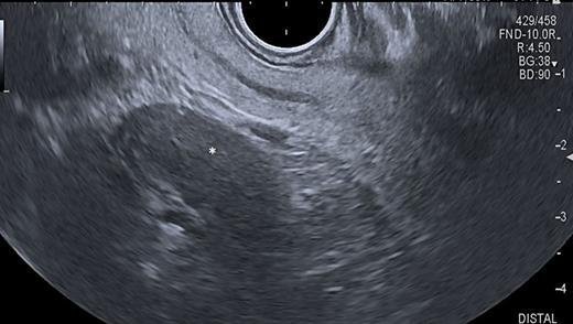 Diagnostic Endoscopic Ultrasound in Pancreatology: Focus on Normal ...