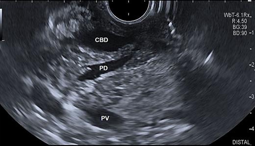 Diagnostic Endoscopic Ultrasound in Pancreatology: Focus on Normal ...