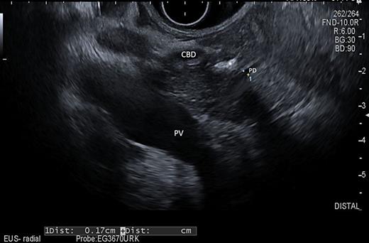 Diagnostic Endoscopic Ultrasound in Pancreatology: Focus on Normal ...
