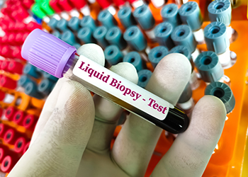 Article Collection: Liquid Biopsy in Diagnosis and Treatment Monitoring ...